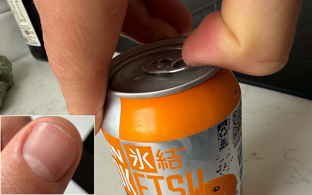 Healing Of Skin Underneath Man's Thumbnail A Sign That Silly Season Is ...